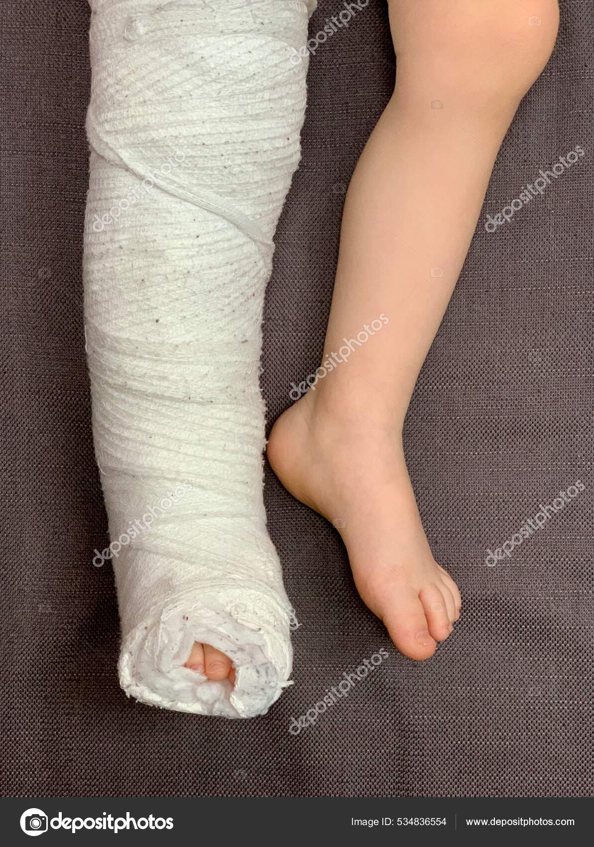 Baby gebrochenes Bein im Gips, Kindheitstrauma, Knochenbruch ...