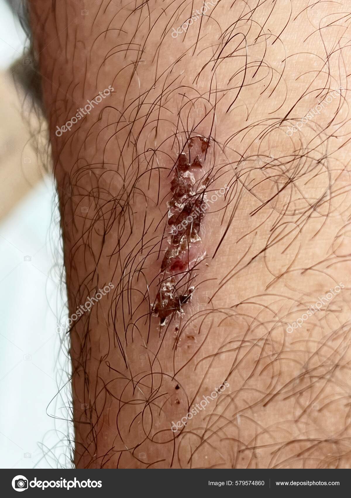 Cicatriz Piel Herida Forma Costras Pierna Hombre Con Larga Herida ...