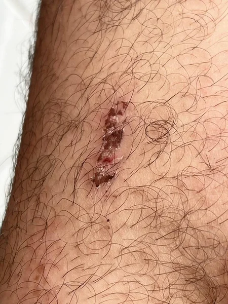 Scar on skin. The wound form scabs on leg. Man with long scab wound on ...