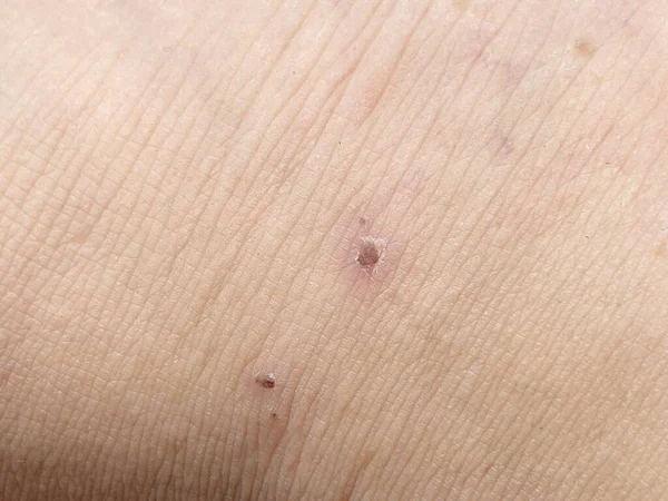 Costra piel fotos de stock, imágenes de Costra piel sin royalties ...