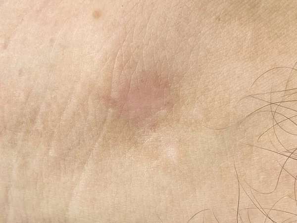 Small red circle on skin images Stock Photos, Royalty Free Small red ...