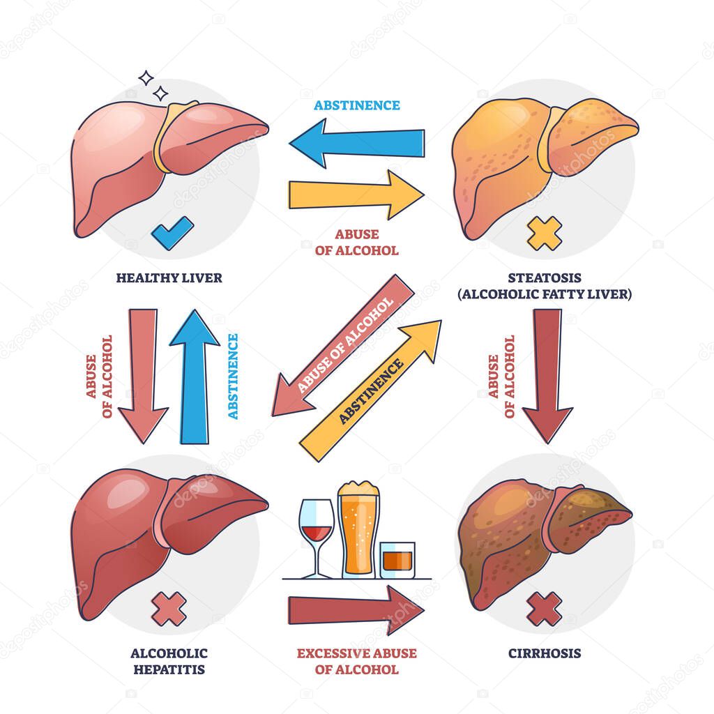 Enfermedad hepática alcohólica por abuso excesivo del concepto de ...