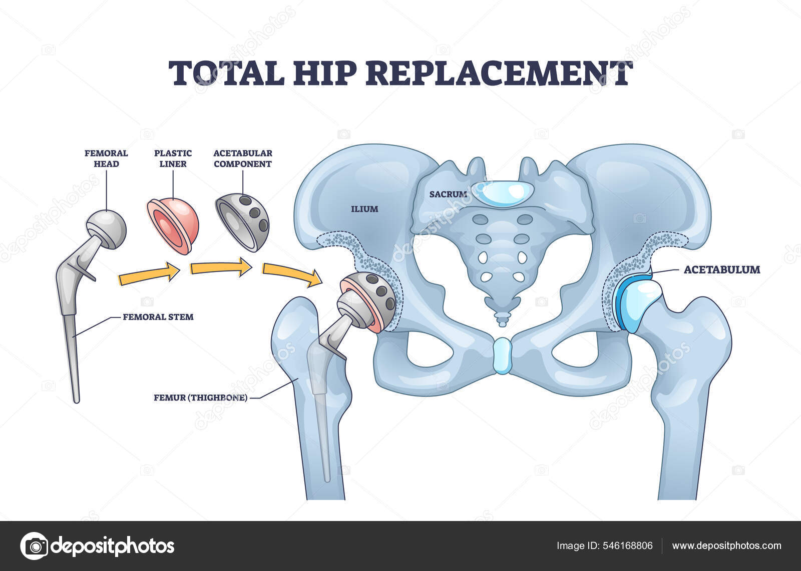 Cirurgia de substituição total do quadril com diagrama de contorno da ...