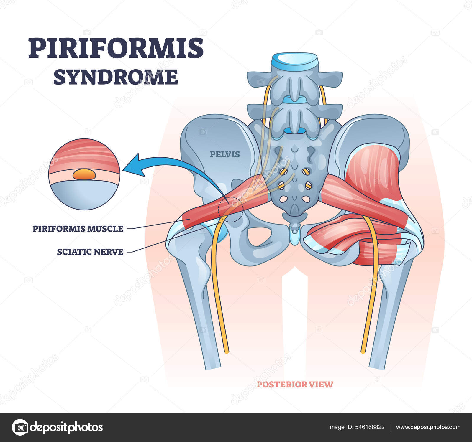 Piriformis syndrome and sciatic nerve compression pain outline diagram ...