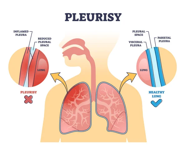 Enfermedad de pleuresía o pleuritis como diagrama de contorno de ...