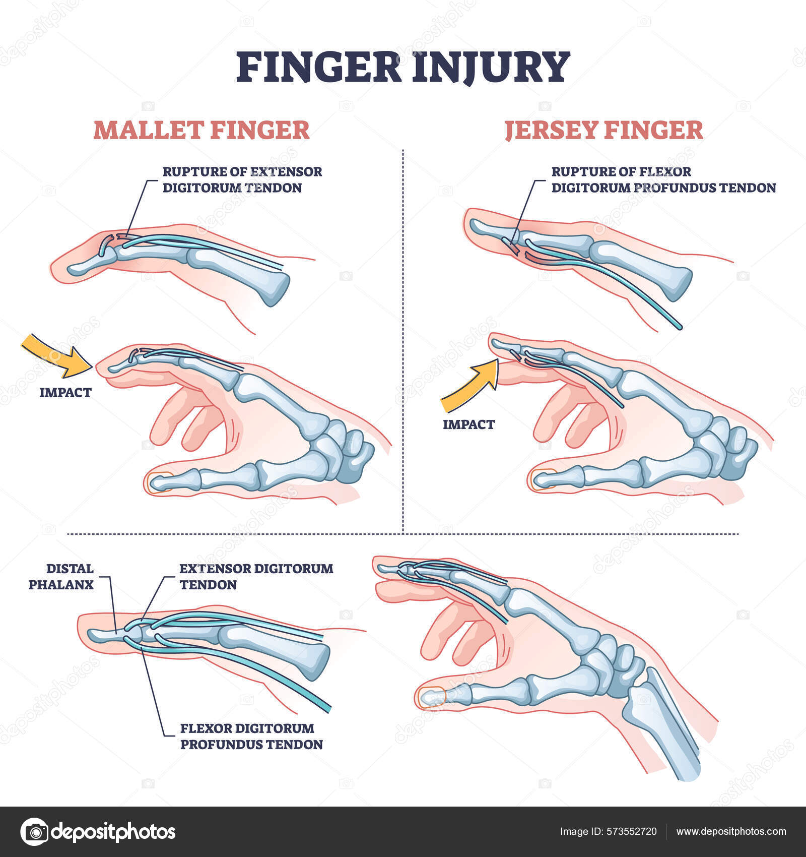 手指伤类型及常见手部撞击伤解剖示意图图库矢量图作者：© VectorMine 573552720