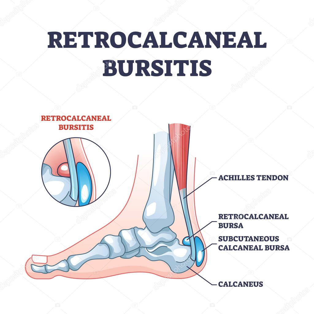 Bursitis retrocalc nea como tobillo o tend n de Aquiles bursa diagrama ...