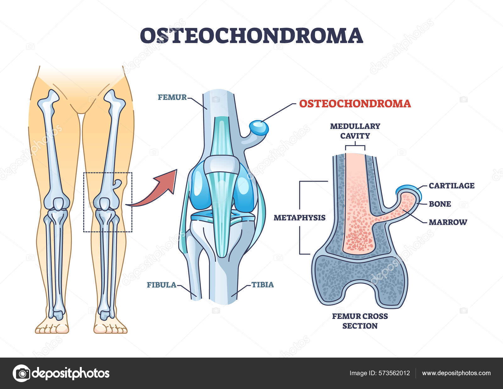 의학적 인 뼈 종양 과잉 성장 윤곽 다이어그램에 있는 골다공증 무릎 문제 스톡 벡터 - ©VectorMine 573562012