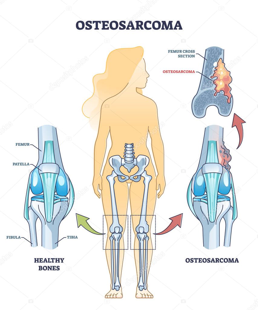 Tumor óseo del osteosarcoma como sarcoma osteogénico Esquema del esquema del cáncer 2024