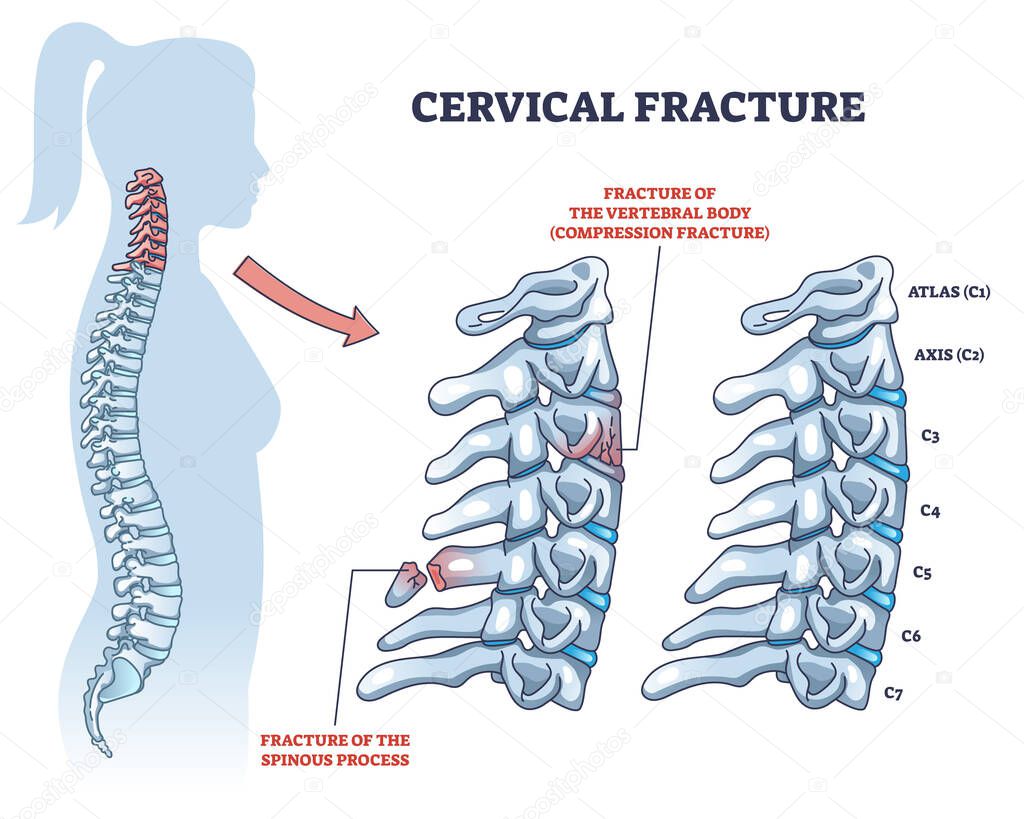 Fractura cervical y daño vertebral y vertebral humano diagrama de ...