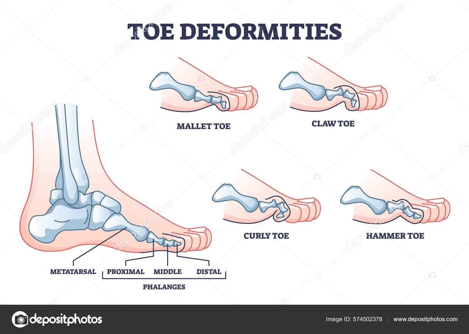 Deformările Degetelor Picioare Falangele Piciorului Defectele Osoase ...