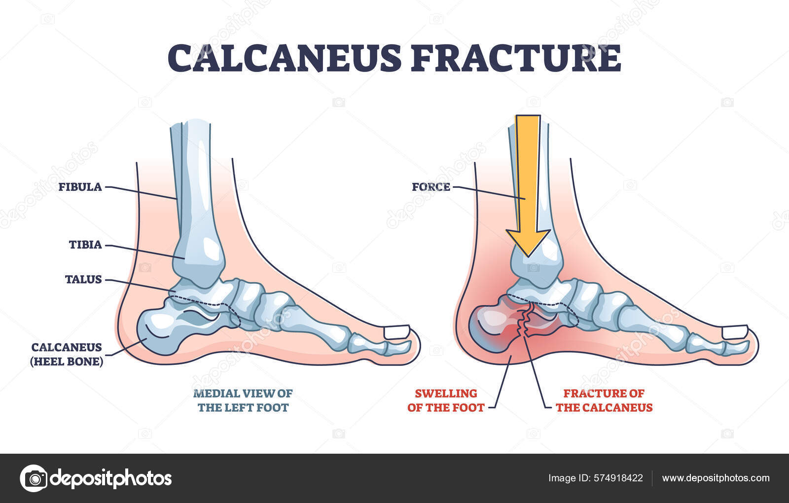 Anatomía Fractura Calcáneo Con Estructura Ósea Del Talón Roto Diagrama ...
