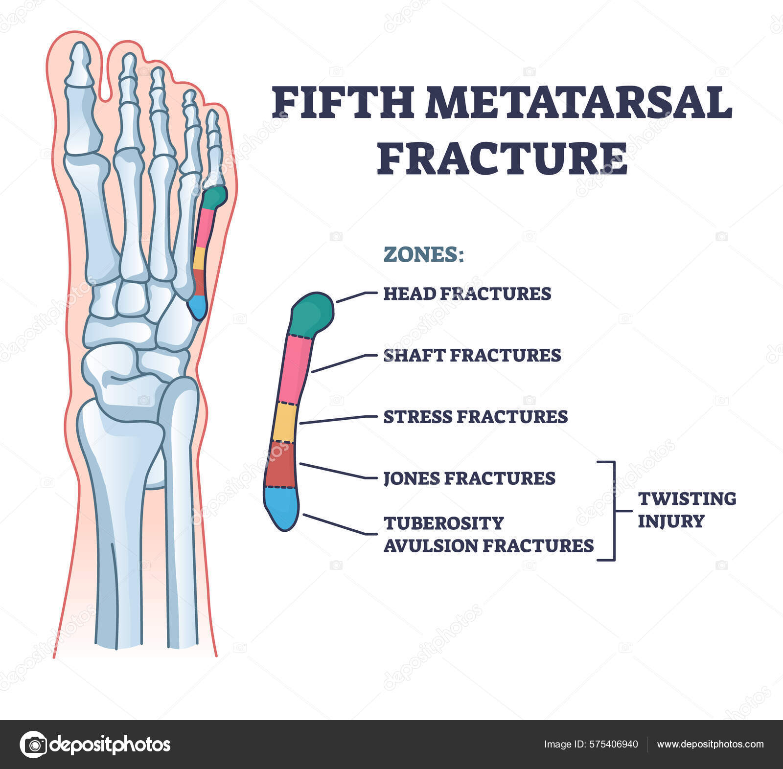 Fifth Metatarsal Foot Little Finger Fracture Injury Outline Diagram ...
