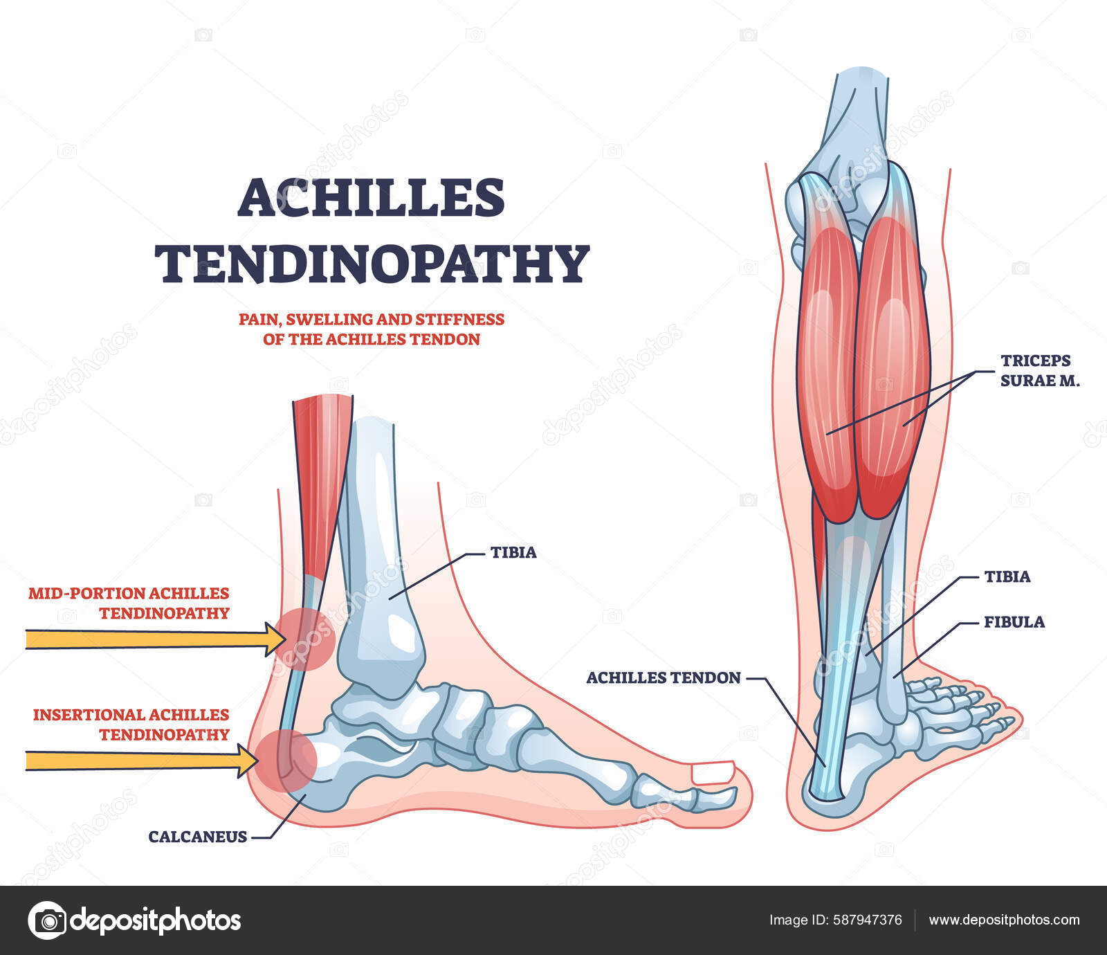 Achilles Tendinopathy Injury Tendon Heel Outline Diagram Labeled Educational Scheme Stock ...