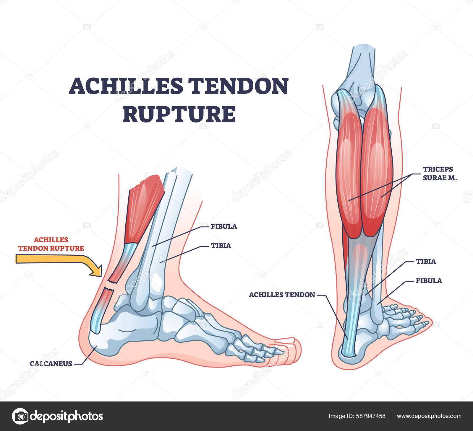 Achilles Tendon Rupture Painful Injury Leg Trauma Outline Diagram ...