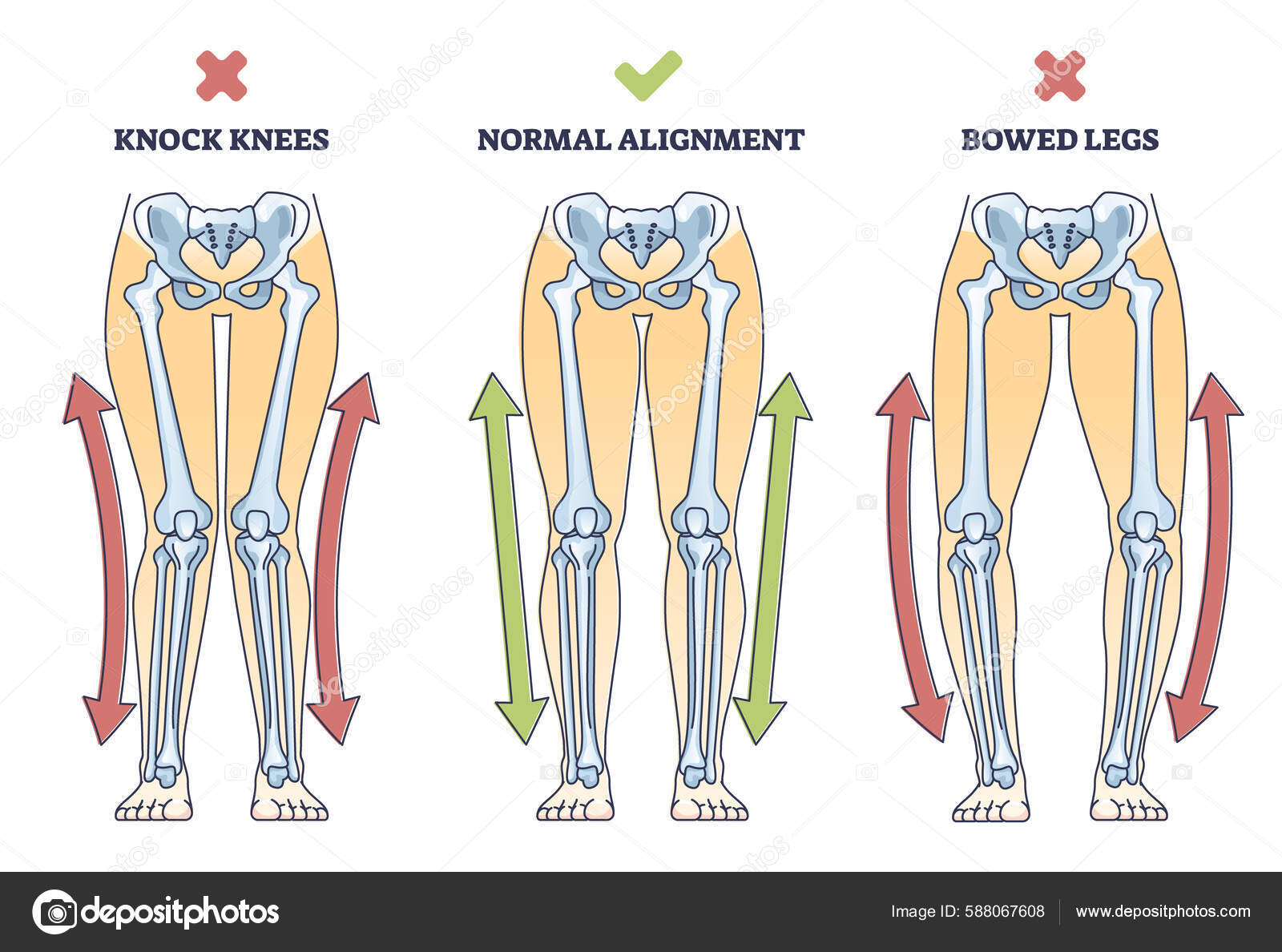 Bowed Legs Syndrome Normal Knock Legs Comparison Outline Diagram ...