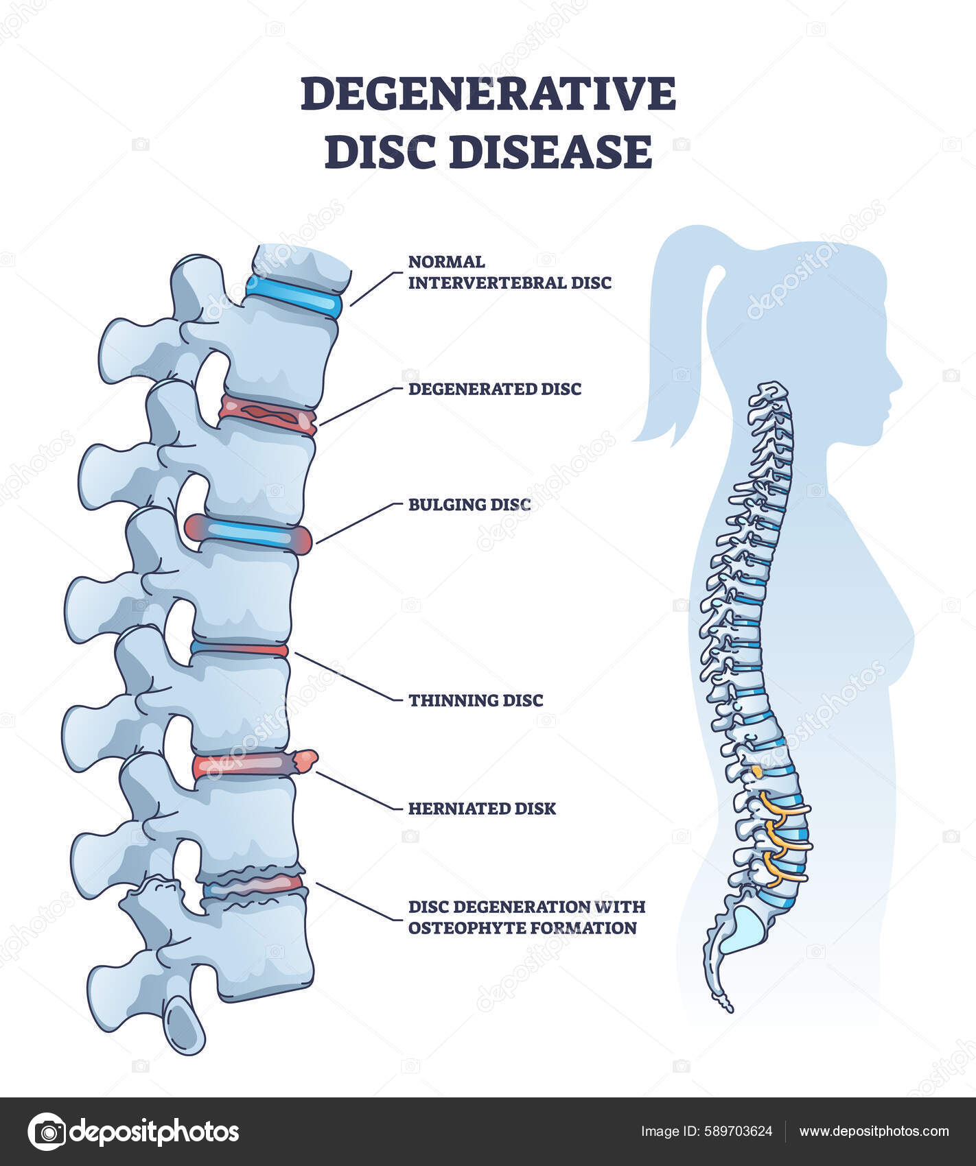 Degenerative Disc Disease Spine Vertebra Trauma Outline Diagram Labeled ...