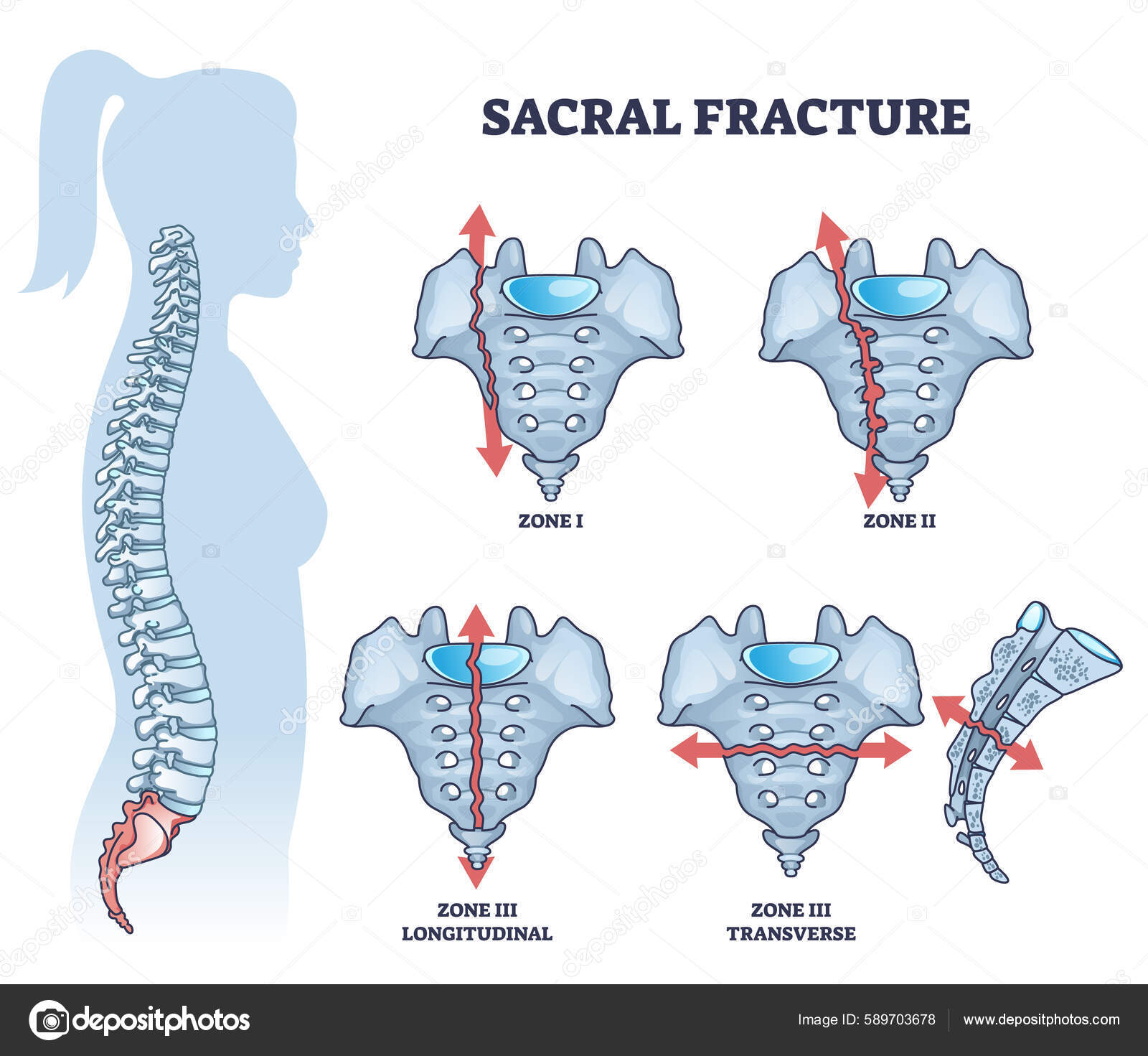 Sacral Fracture Backbone Skeletal Trauma Injury Types Outline Diagram Labeled Vector de stock ...
