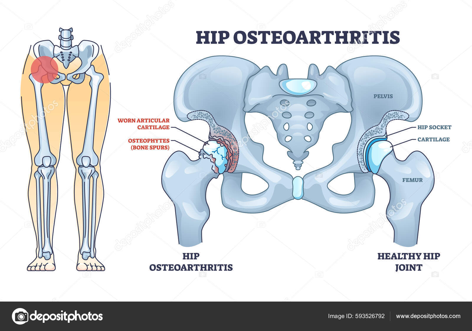 Hip Osteoarthritis Bone Disease Painful Skeletal Spurs Outline Diagram ...