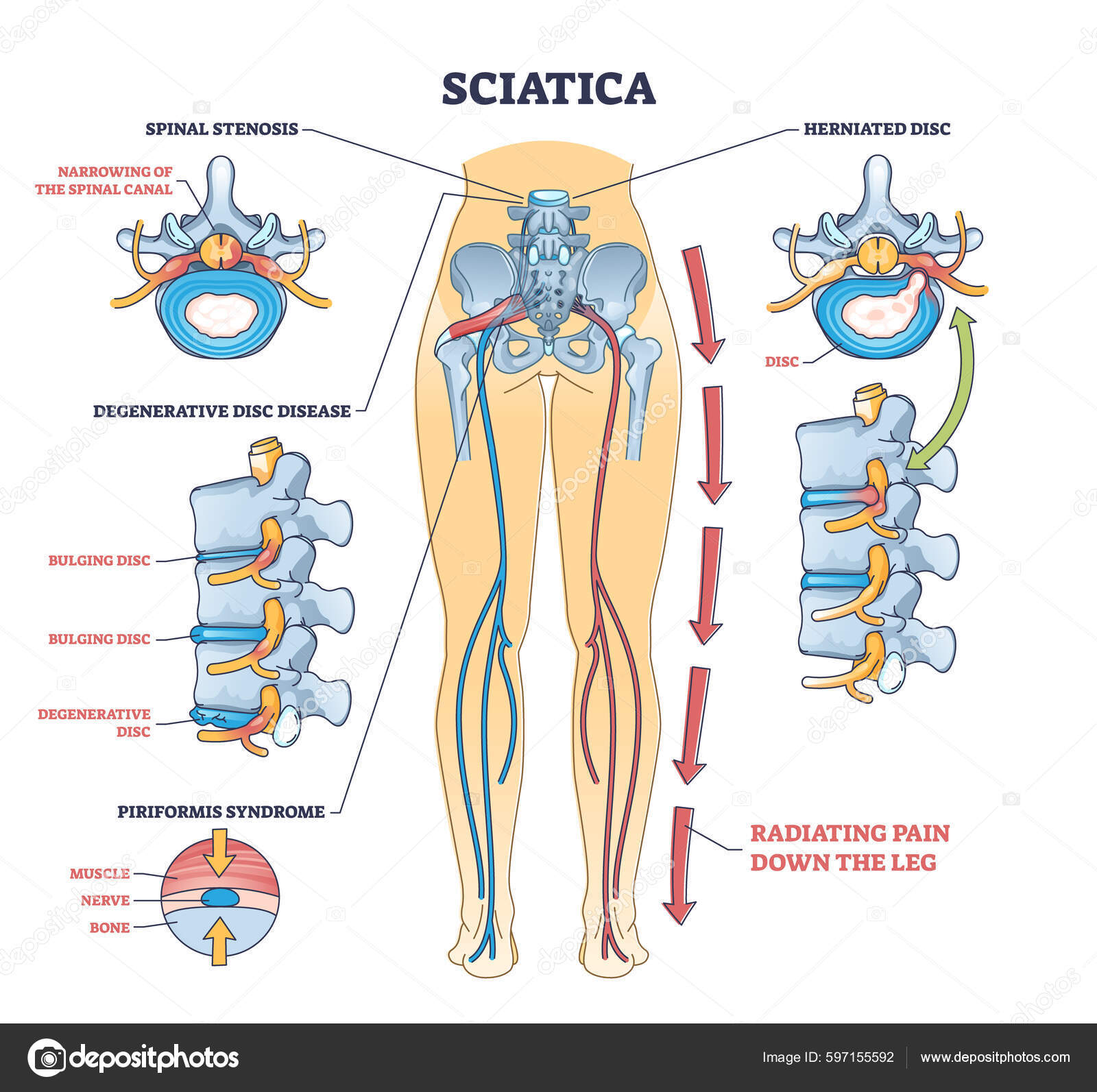 Sciatica Pain Nerve Weakness Leg Lumbar Radiculopathy Outline Diagram ...