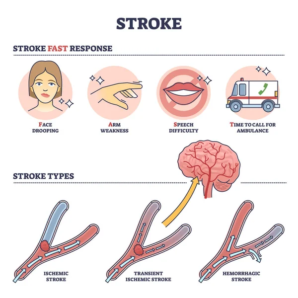 Stroke medical condition with fast response and types outline diagram. Labeled educational ...