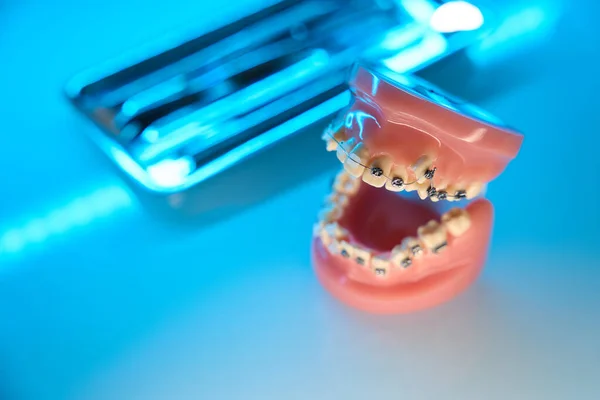 Model of an open jaw with braces on the teeth. Orthodontic kit for ...