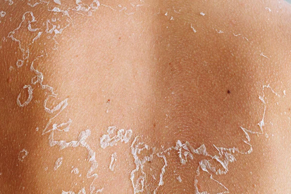 Llagas en la piel Stock Photos, Royalty Free Llagas en la piel Images ...