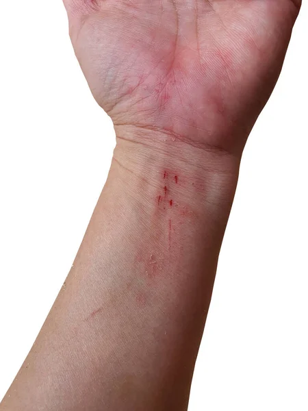 Skin allergy scratch Stock Photos, Royalty Free Skin allergy scratch ...