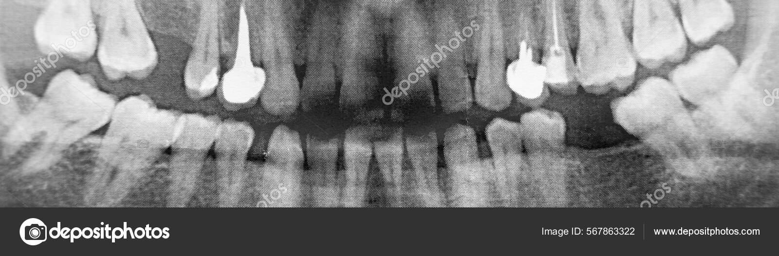 Ray Man's Jaw 360 Degrees Very High Noise Two Implants — Stock Photo ...