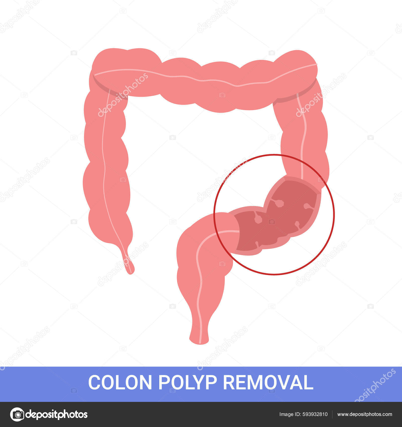 Colonoscopy Intestine Polypectomy Procedure Removal Polyp Colon Colon ...