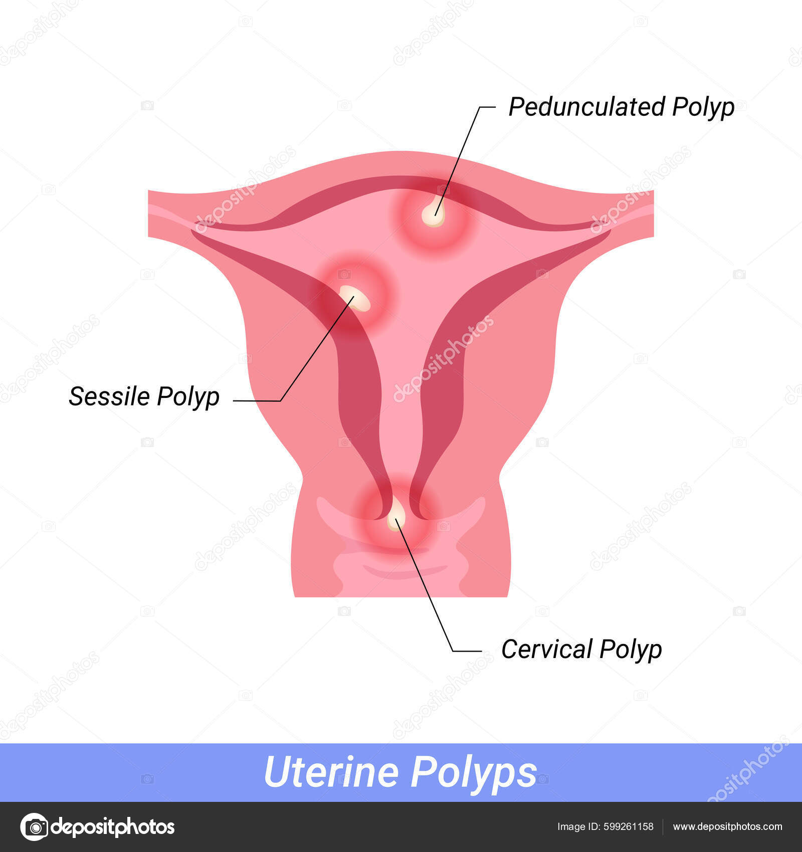 Polyps Uterus Female Reproductive System Human Anatomy Internal Organs
