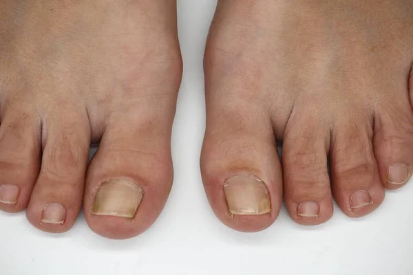 Big toe nail of a person suffering from onychomycosis, a fungal ...