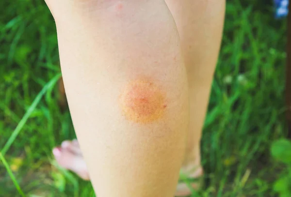 Paintball bruises Stock Photos, Royalty Free Paintball bruises Images ...