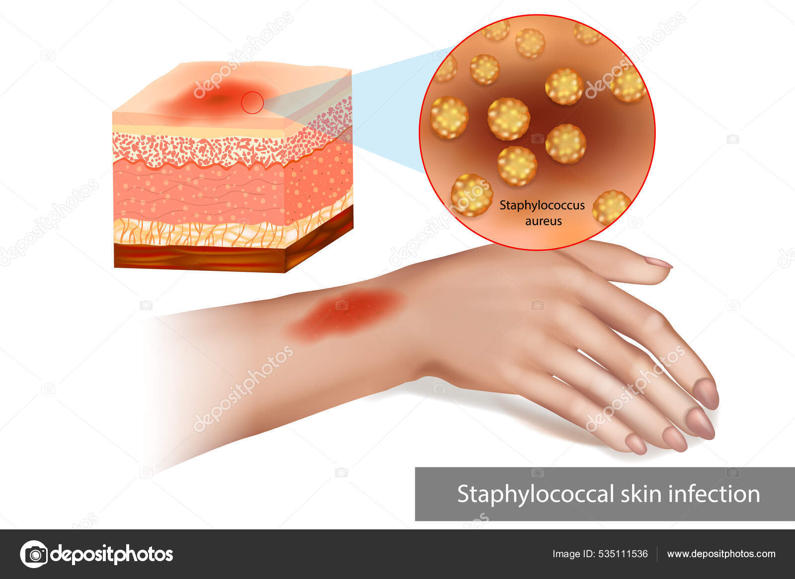 Infección estafilocócica de la piel o infección por estafilococo ...