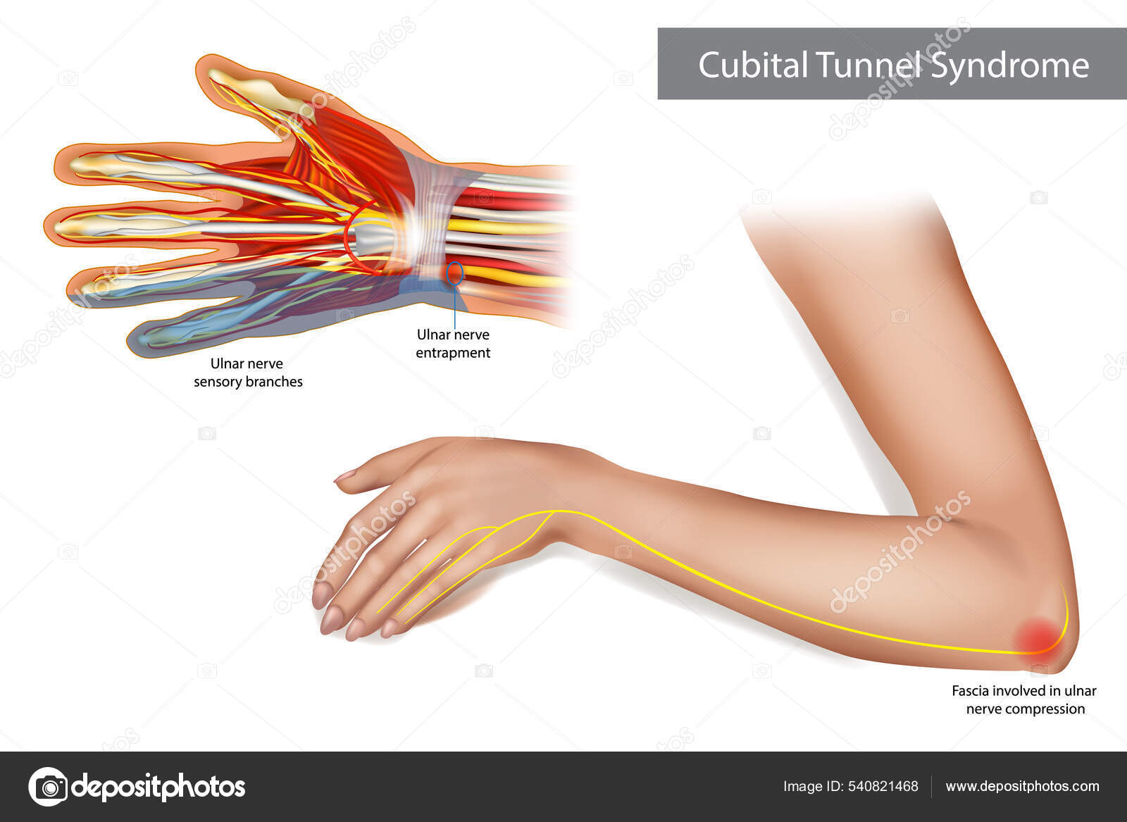 Medical illustration to explain Cubital tunnel syndrome. Ulnar nerve ...