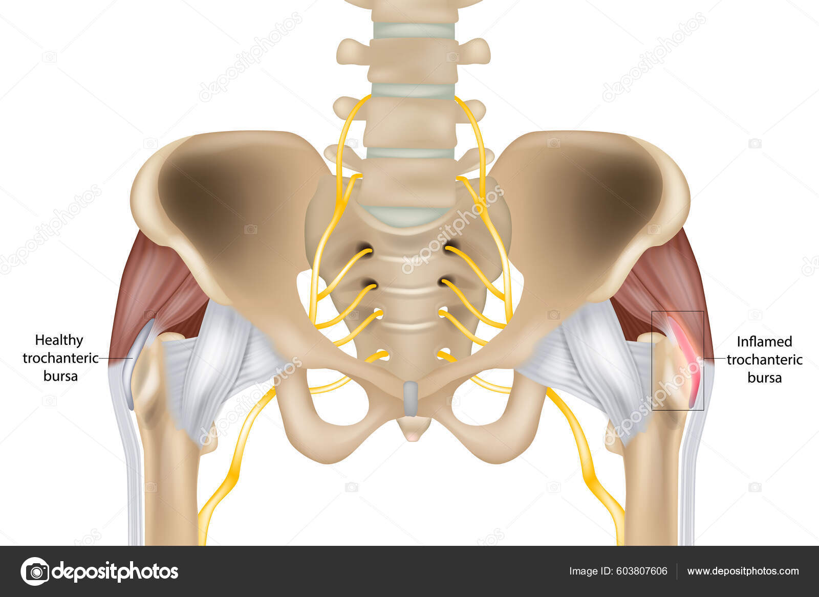 Hip Trochanteric Bursitis Inflammation Bursa Illustration Healthy Inflamed Trochanteric Bursa ...