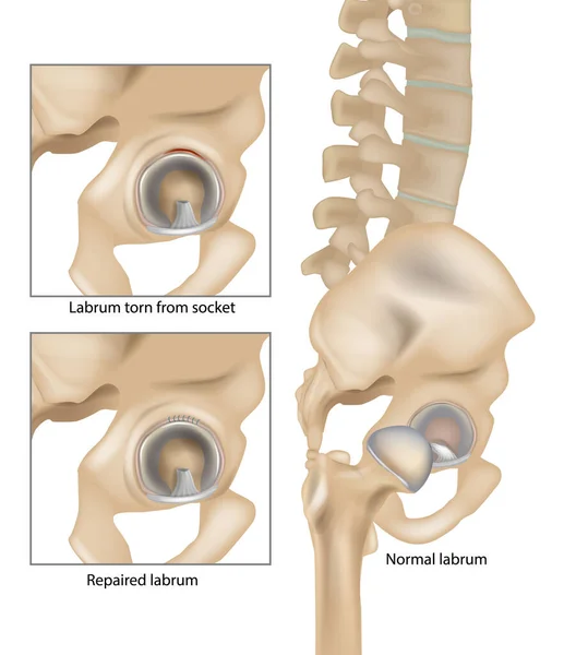 Lágrimas de Hip Labral. Labrum arrancado del zócalo y labrum reparado ...