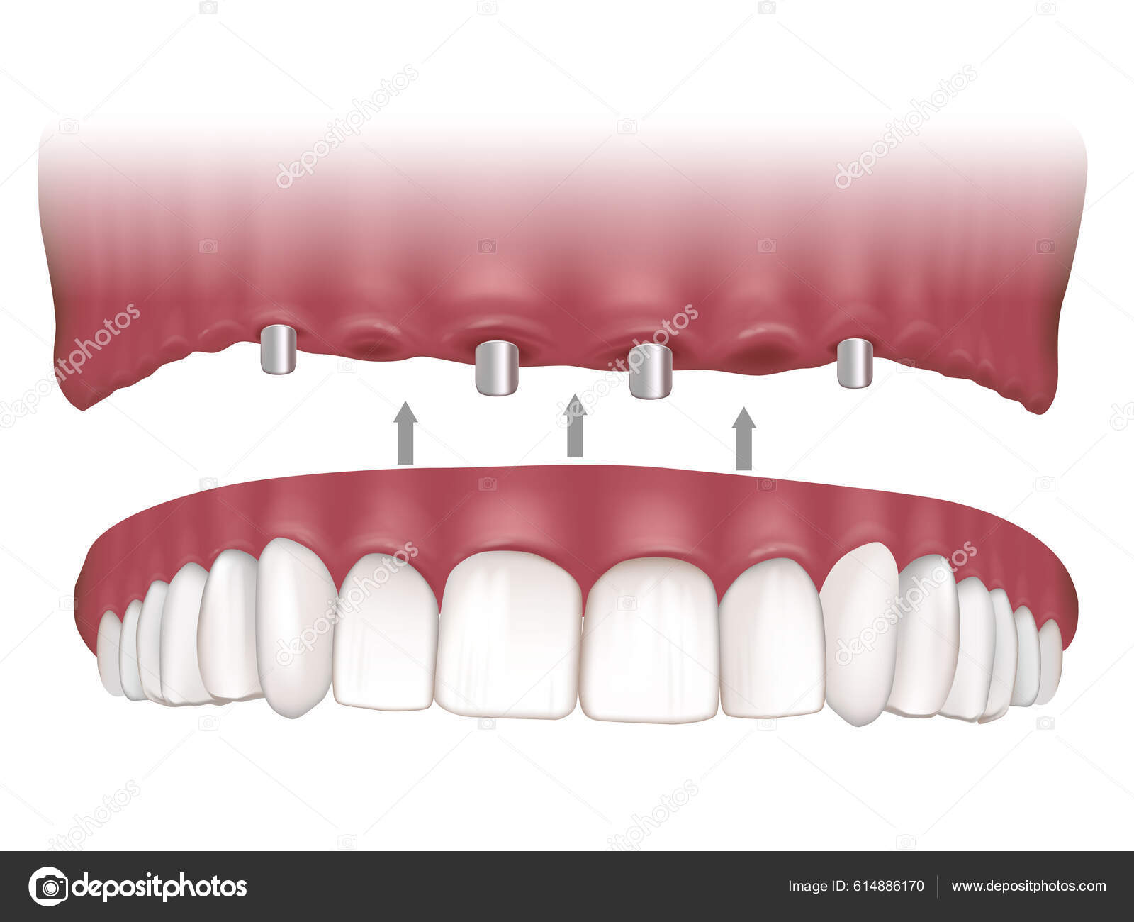 Maxillary Implant Supported Fixed Prosthesis Maxillary Overdentures ...