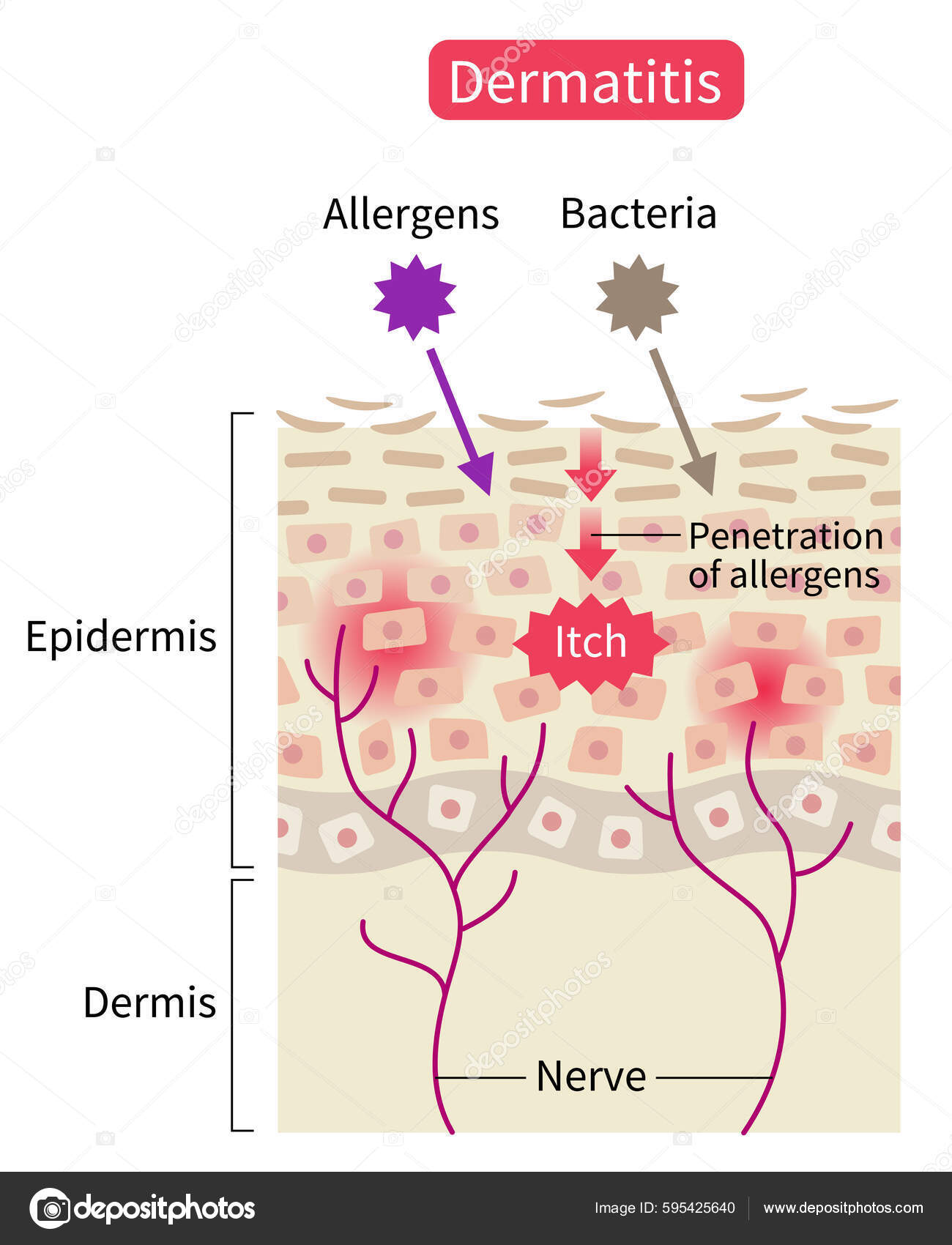 Atopic Dermatitis Eczema Skin Disrupt Moisture Barrier Allows Penetrate ...