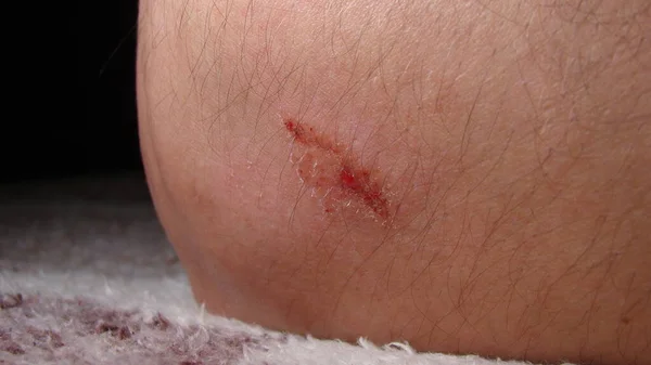 Leg wound Stock Photos, Royalty Free Leg wound Images | Depositphotos