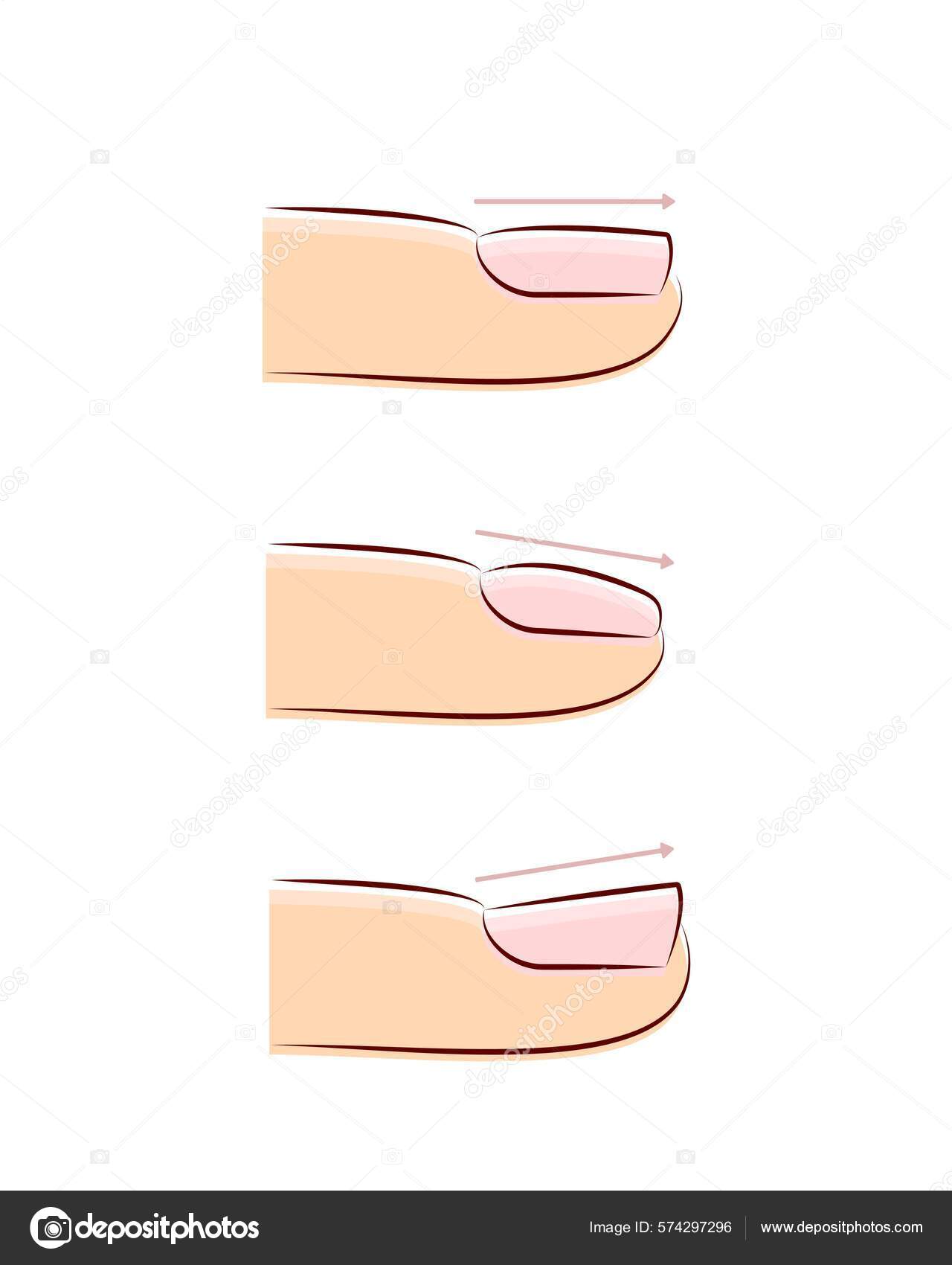 Direction Nail Growth Different Types Fingernail Flat Convex Concave ...