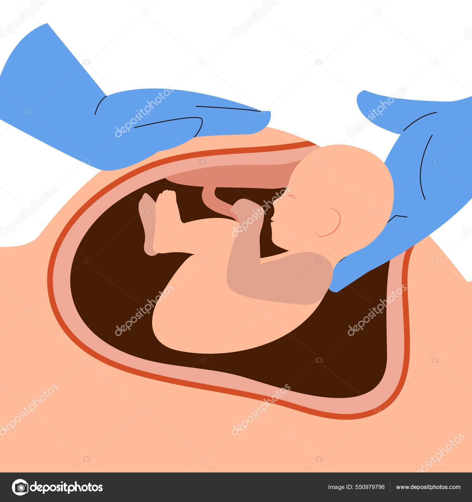 Illustration Section Cesarean Process Stock Vector Image by ©Gegambar #550979796