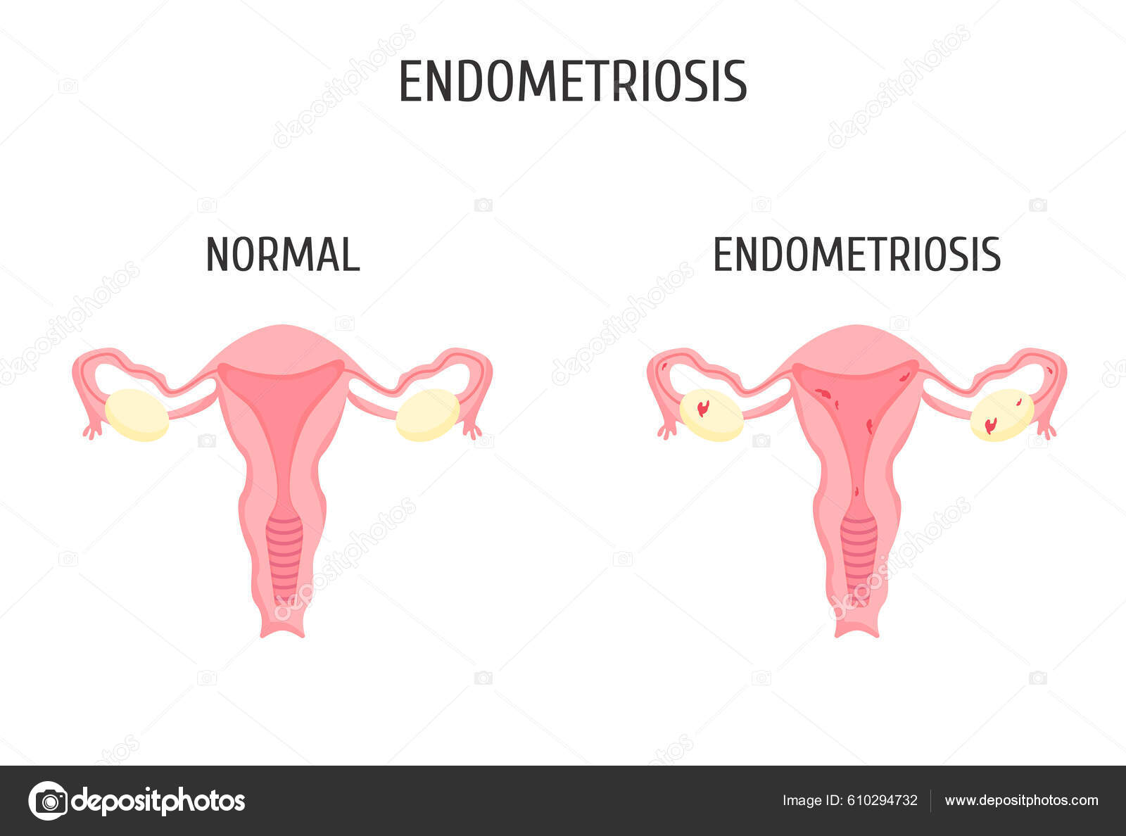 Órgãos Genitais Femininos Com Sem Endometriose Infográficos imagem ...