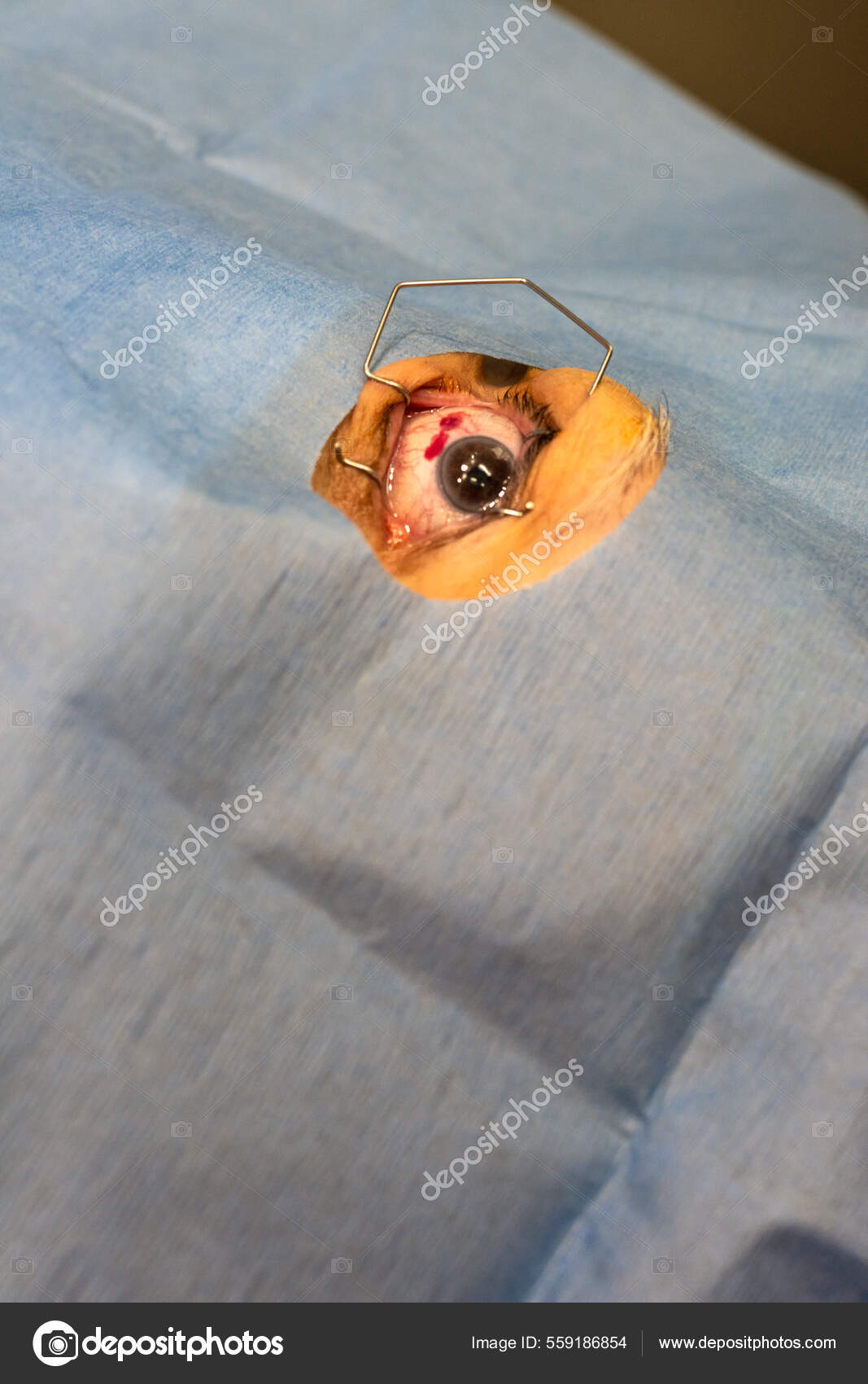 Close Human Eye Ophthalmology Operating Room Opened Blepharostat ...