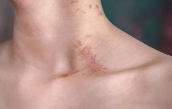 Dry Skin Rash On Neck