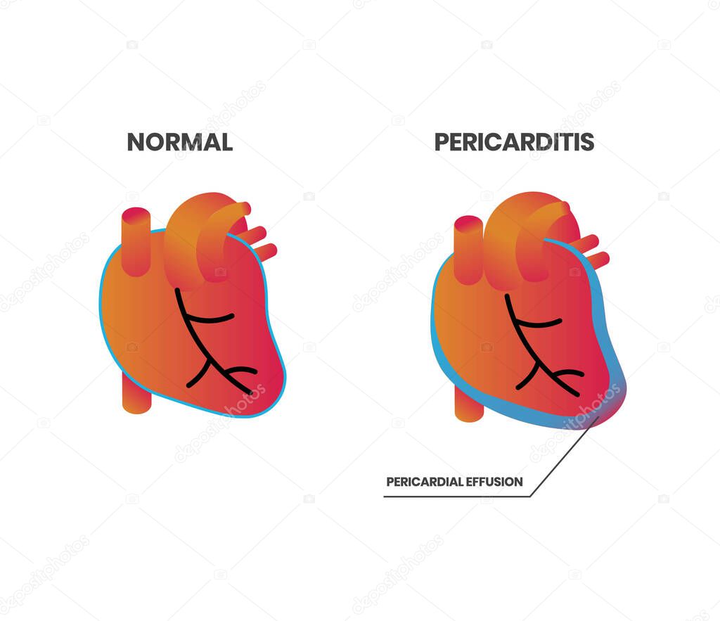 Anatomía normal del corazón vs pericarditis ilustración vectorial ...