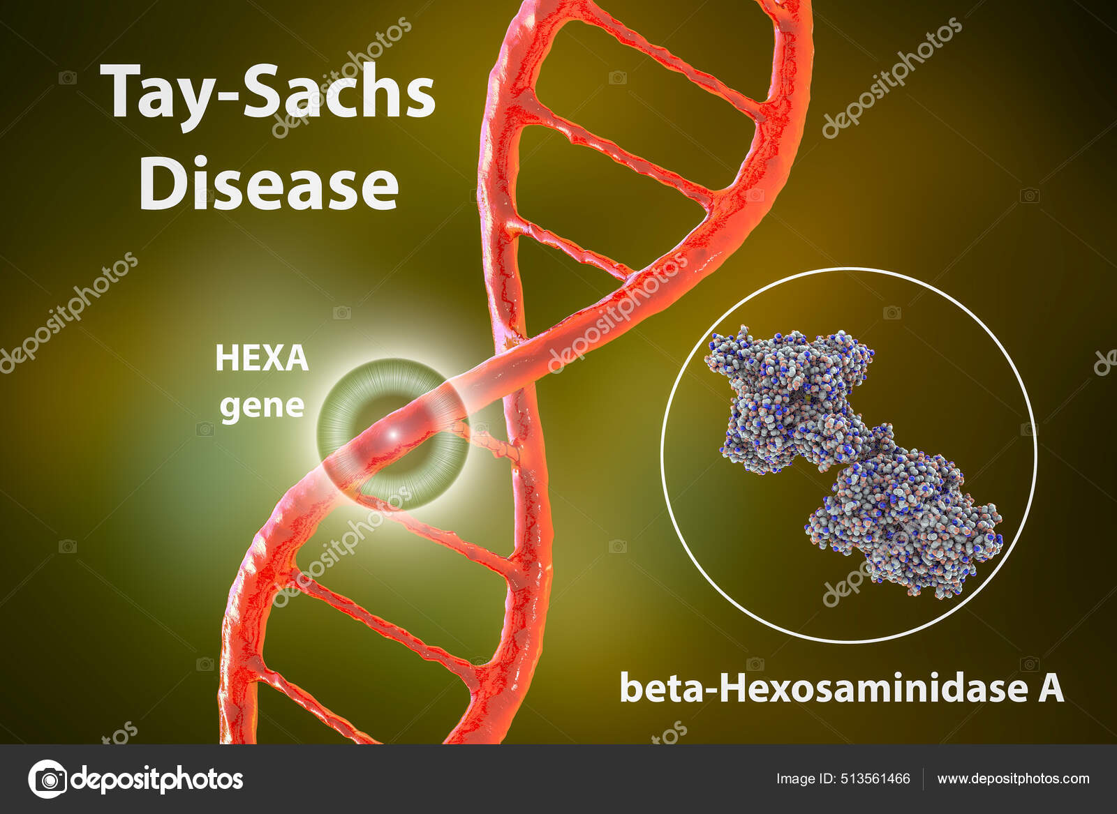 Tay Sachs Disease Illustration Genetic Disorder Progressively Destroys ...