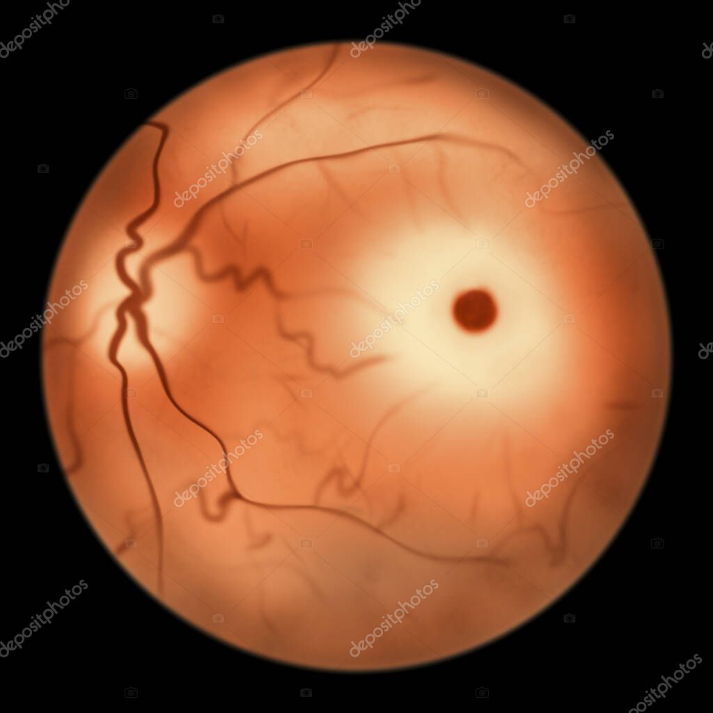Retina ocular en enfermedades de almacenamiento de esfingolípidos ...