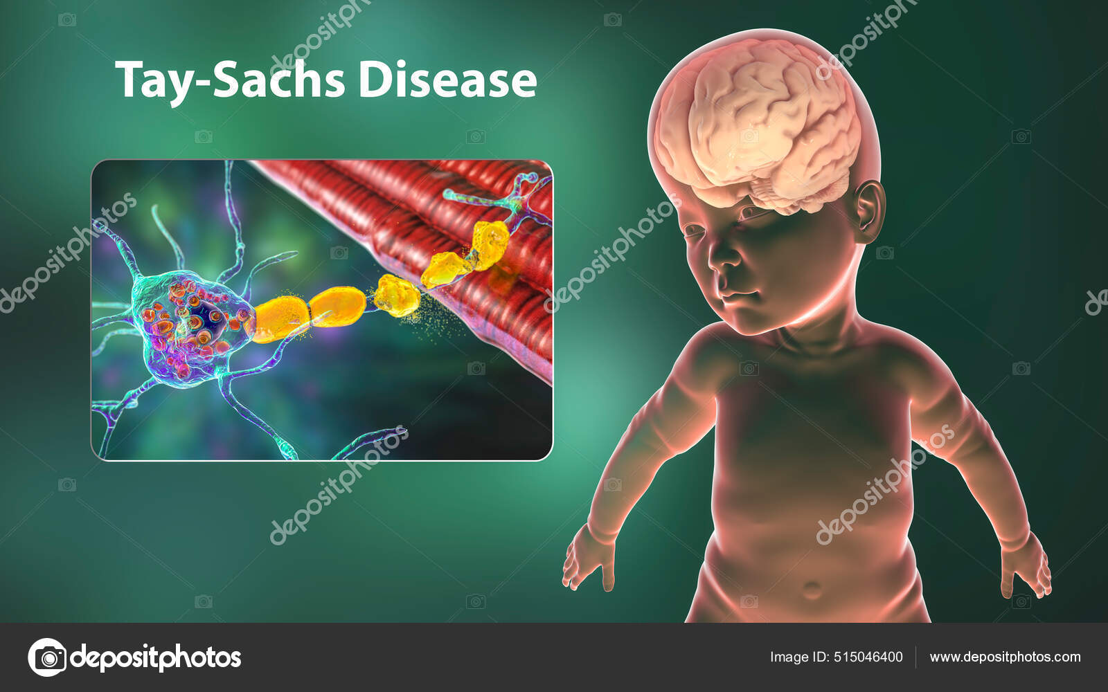 Tay Sachs Disease Lysosomal Storage Genetic Disorder Illustration Child ...