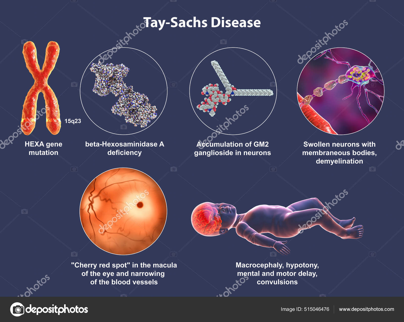 Tay Sachs Disease Illustration Genetic Disorder Progressively Destroys ...